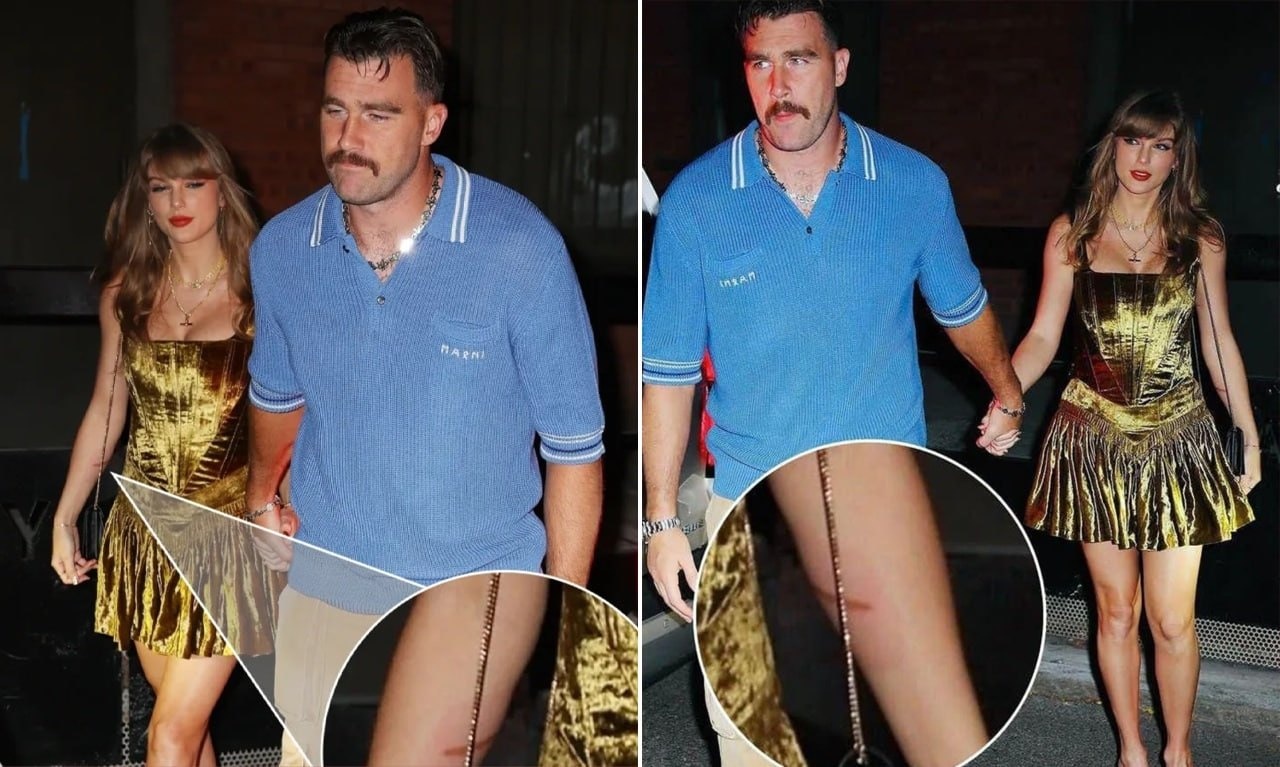 LATEST NEWS: Fans recently discovered Taylor Swift’s noticeable burns ...