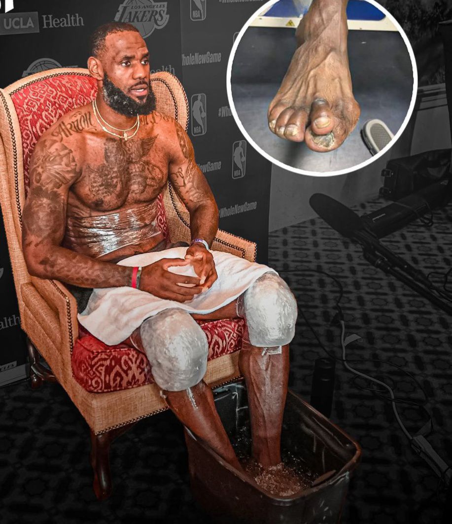 LeBron James’ Scary-Looking Feet, Jacked Up Toes Go Viral - News